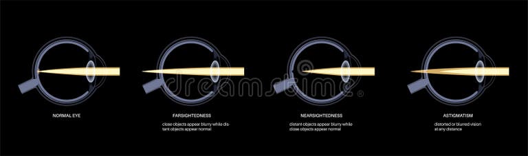 Refractive errors poster stock vector. Illustration of farsightedness ...