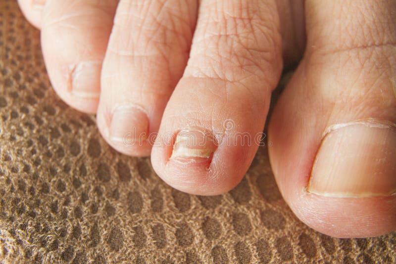 Regrown Foot Nail stock image. Image of healed, trauma - 26662347