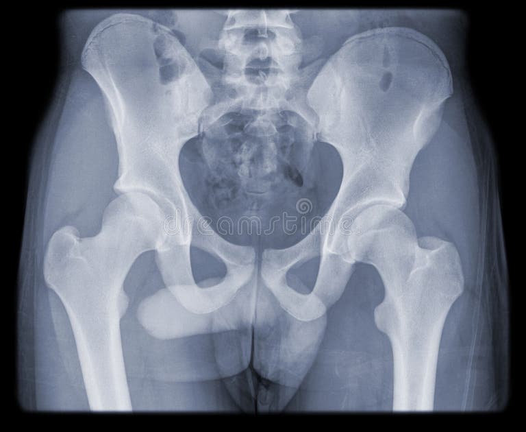 631 Pelvis Radiography Stock Photos - Free & Royalty-Free Stock Photos ...