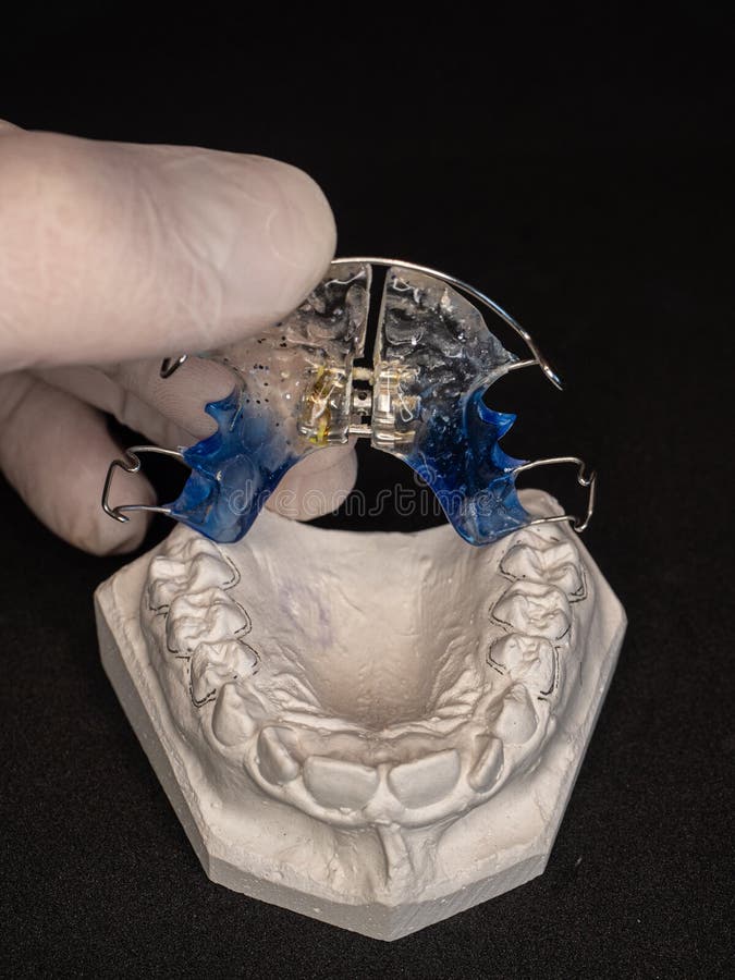 Removable Brace or Retainer for Fix Birth Defect Stock Image - Image of ...