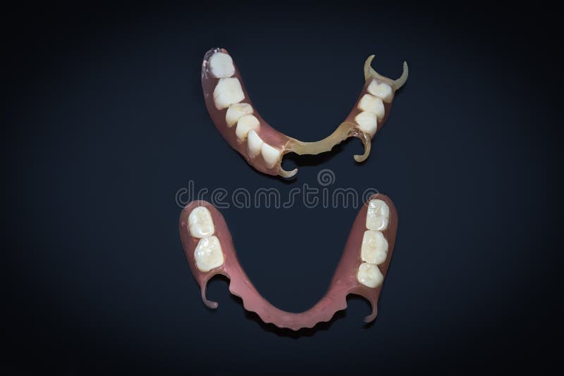 Flexible Partial Dentures Top Teeth Stock Photos - Free & Royalty-Free ...