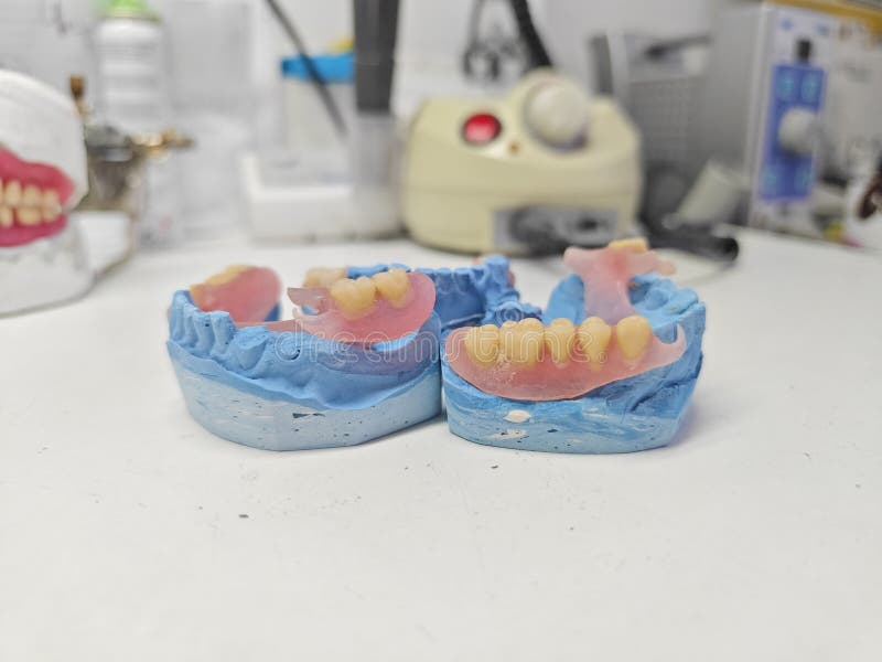 Removable Dentures for the Patient are Made in a Dental Laboratory ...
