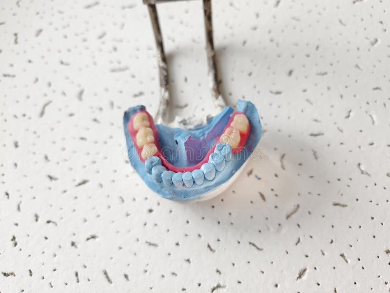 Removable Dentures for the Patient are Made in a Dental Laboratory ...