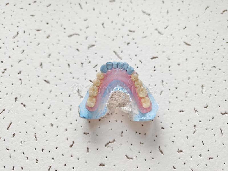 Removable Dentures for the Patient are Made in a Dental Laboratory ...