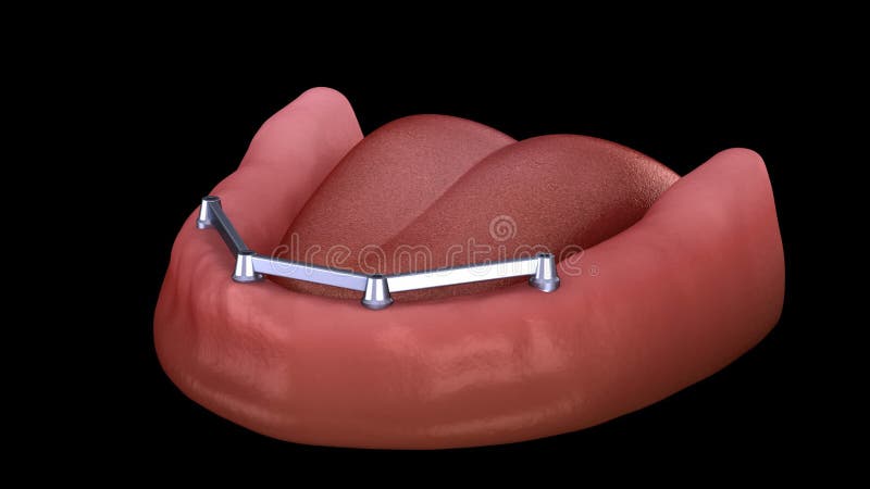 Mandibular Prosthesis All on 4 System Supported by Implants. Medically ...