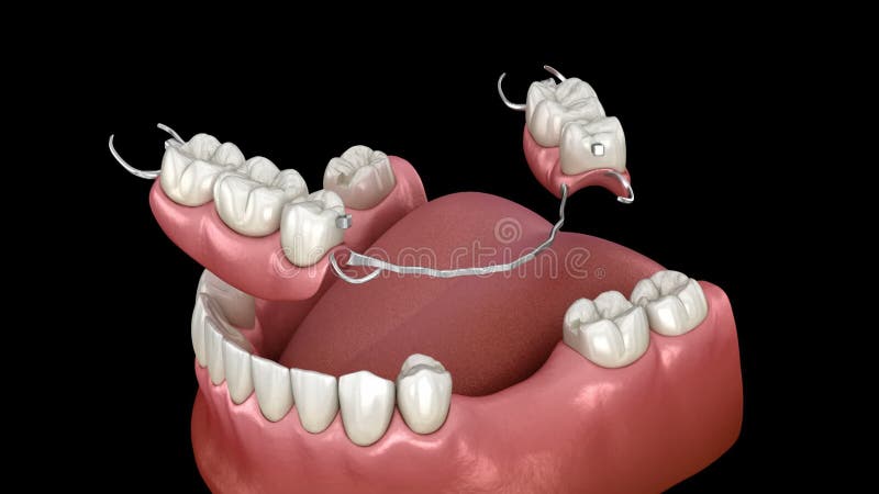 Mandibular Prosthesis All on 4 System Supported by Implants. Medically ...