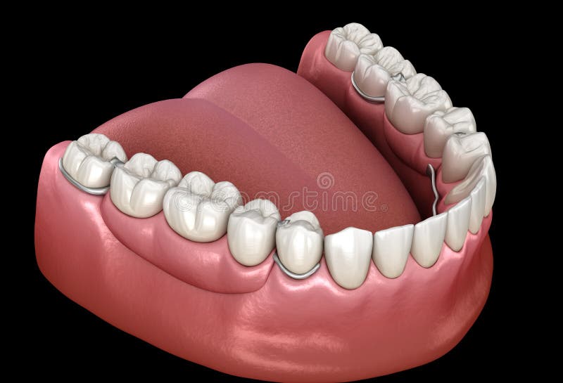 Removable Partial Denture, Mandibular Prosthesis. Medically Accurate 3D ...