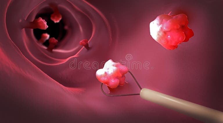 Removal Polyp Stock Illustrations – 111 Removal Polyp Stock ...