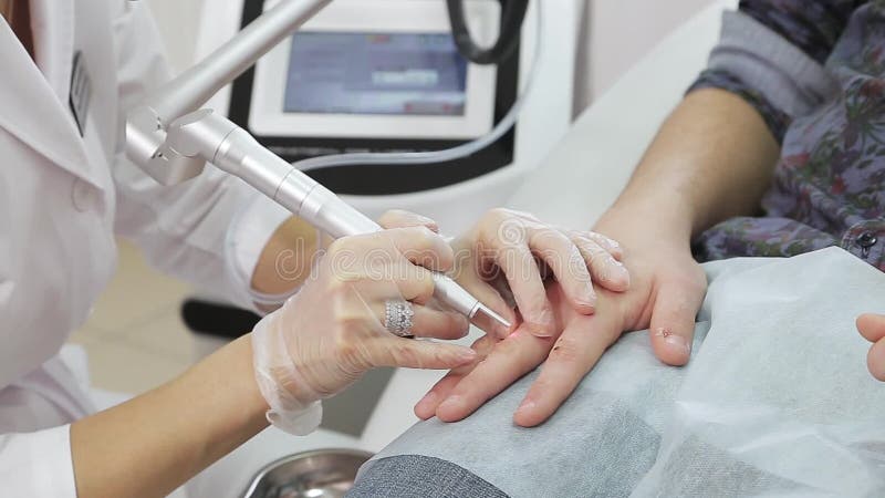 Removal of Warts Laser on the Fingers. Close-up Stock Video - Video of ...