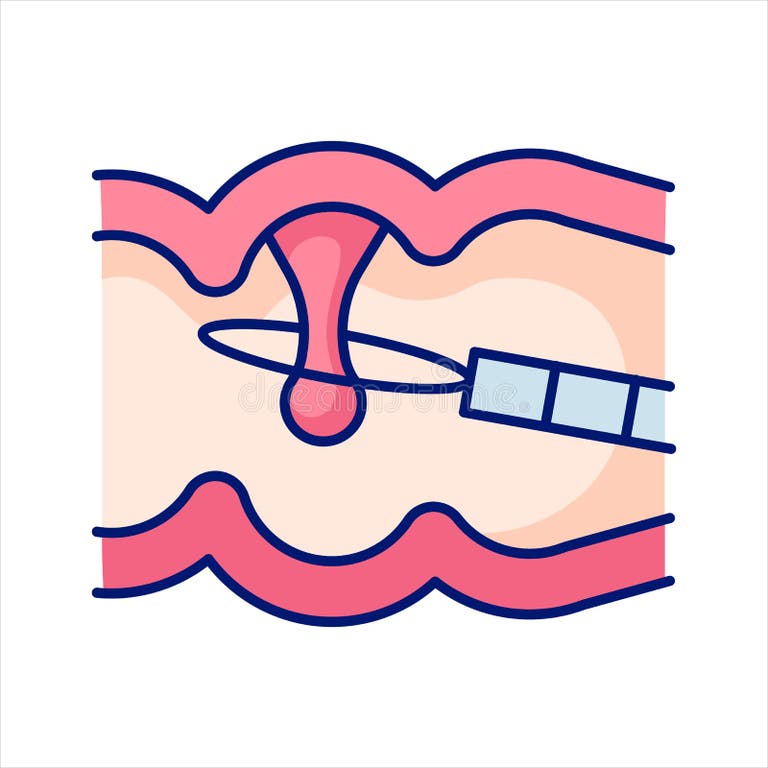 Proctoscopy Stock Illustrations – 15 Proctoscopy Stock Illustrations ...