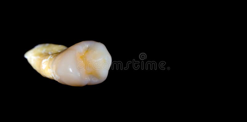 Extracted Tooth with Strange, Curved Root Stock Photo - Image of white ...