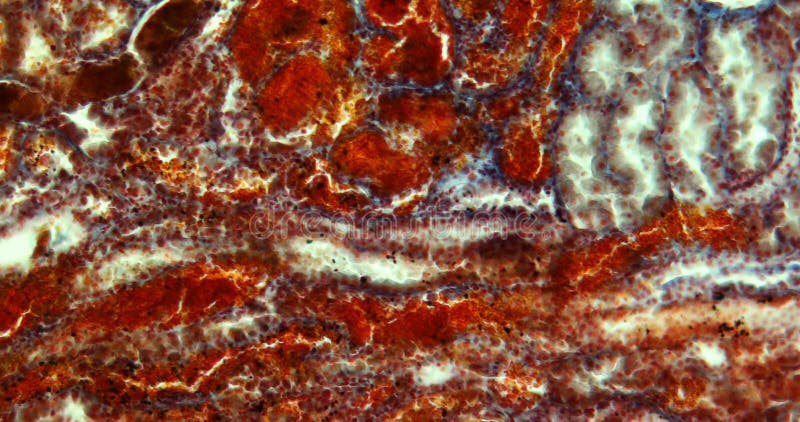 Renal bleeding tissue stock video. Video of liver, sickness - 196631473