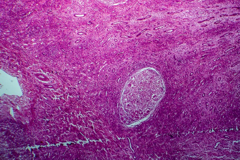 Renal Tuberculosis, Light Micrograph Stock Image - Image of microscope ...