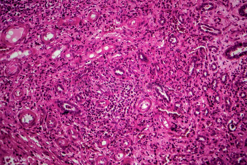 Renal Tuberculosis, Light Micrograph Stock Image - Image of medical ...