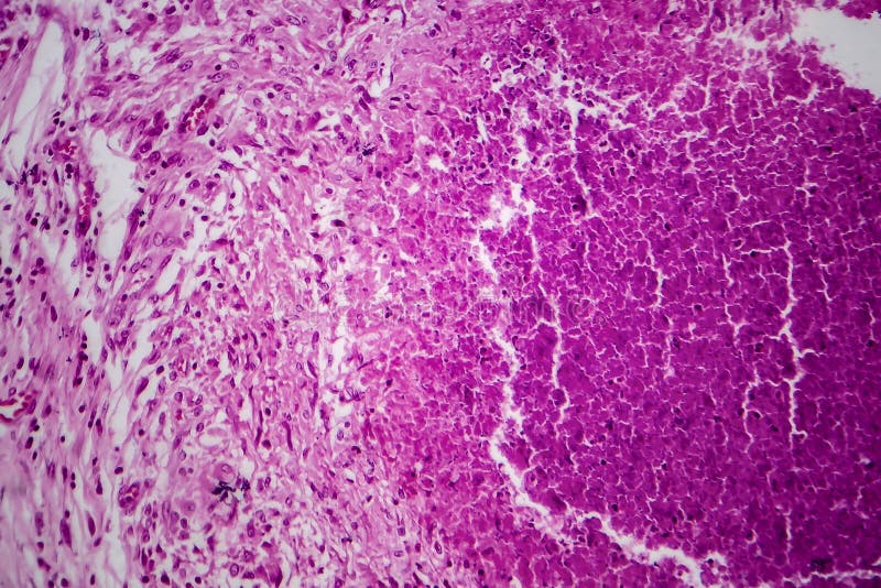 Renal Tuberculosis, Light Micrograph Stock Image - Image of pathology ...