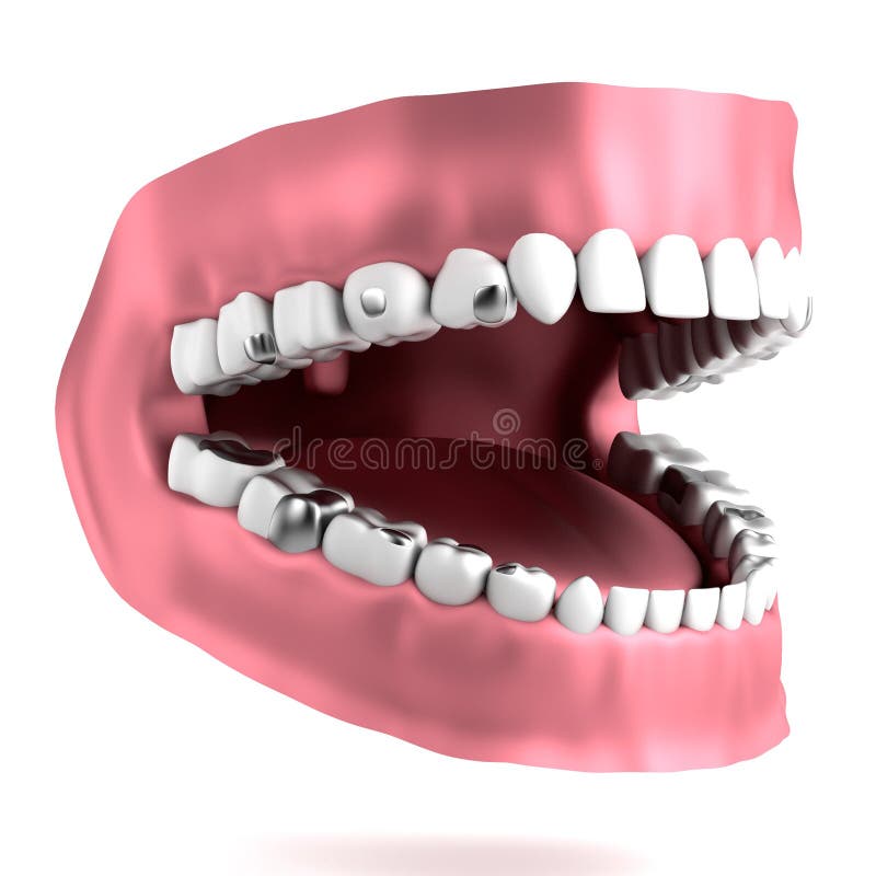 Teeth Lead Fillings Stock Illustrations – 4 Teeth Lead Fillings Stock ...