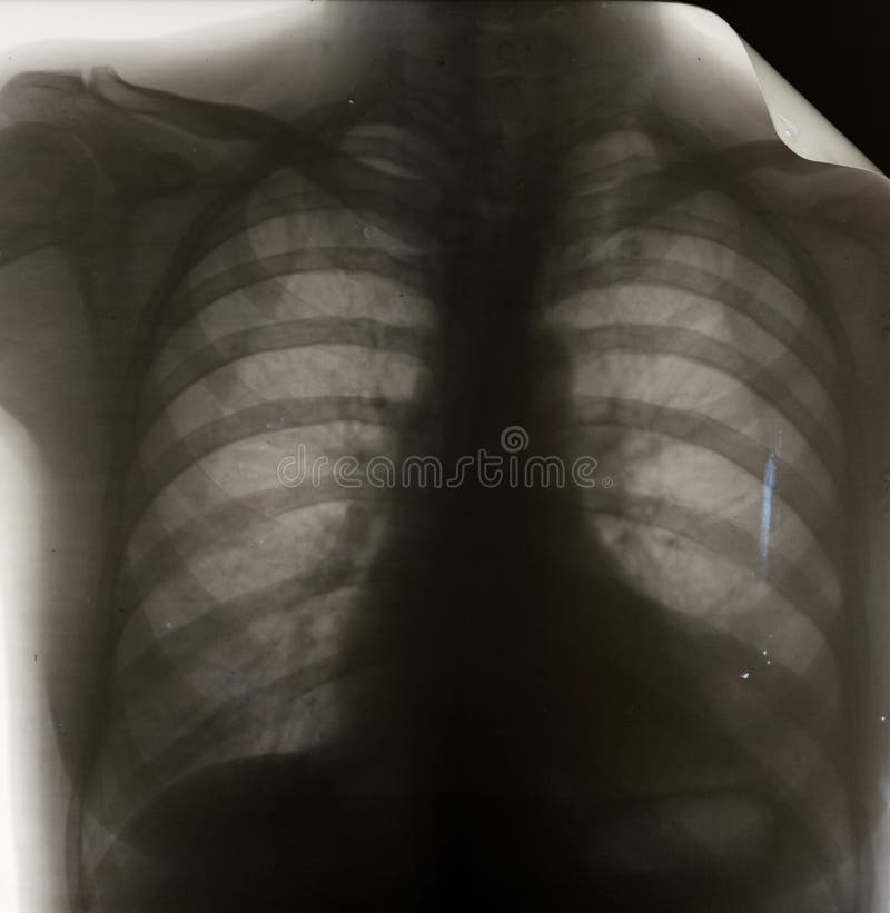 Rengen picture bone stock image. Image of hospital, science - 103476083