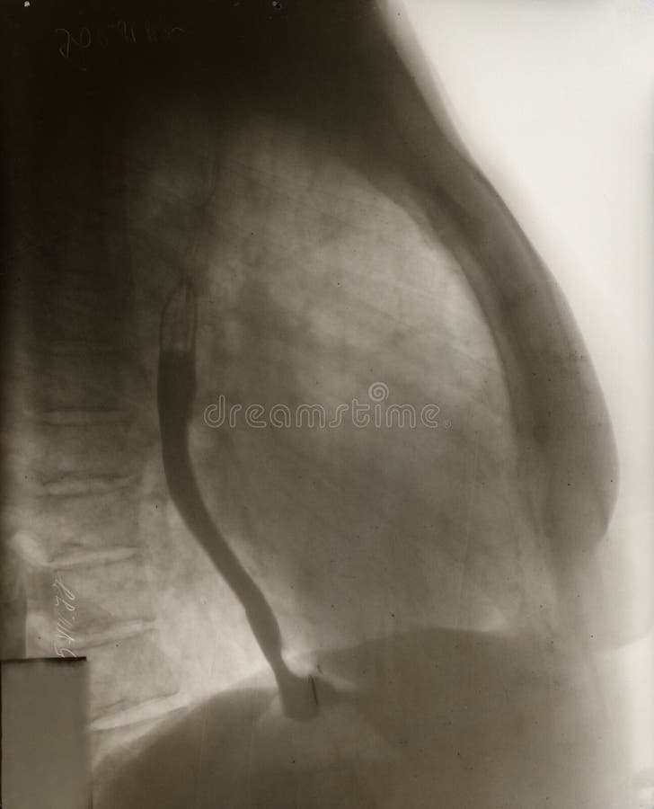 Rengen picture bone stock photo. Image of calcium, negative - 103475998