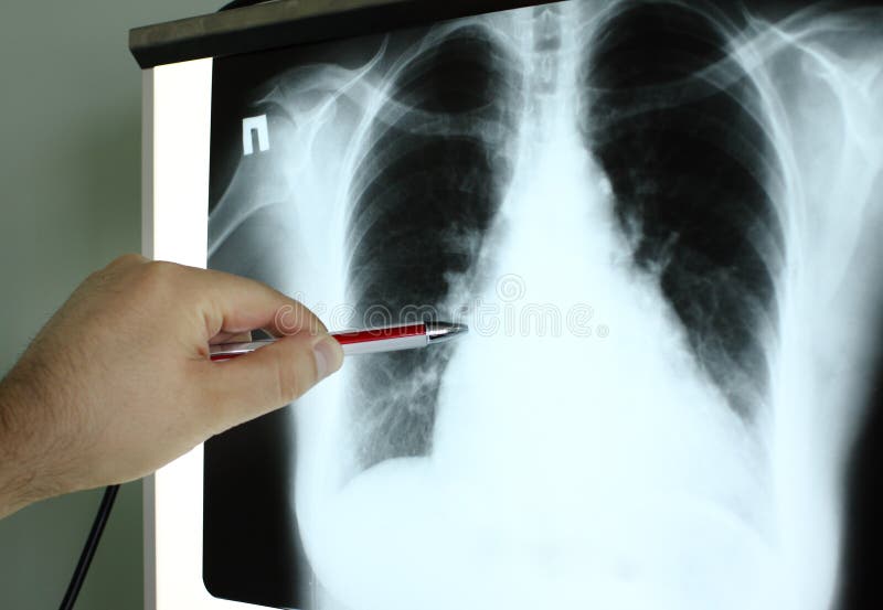 Rentgen the Lungs and the Doctor S Hand with Pen. Stock Image - Image ...