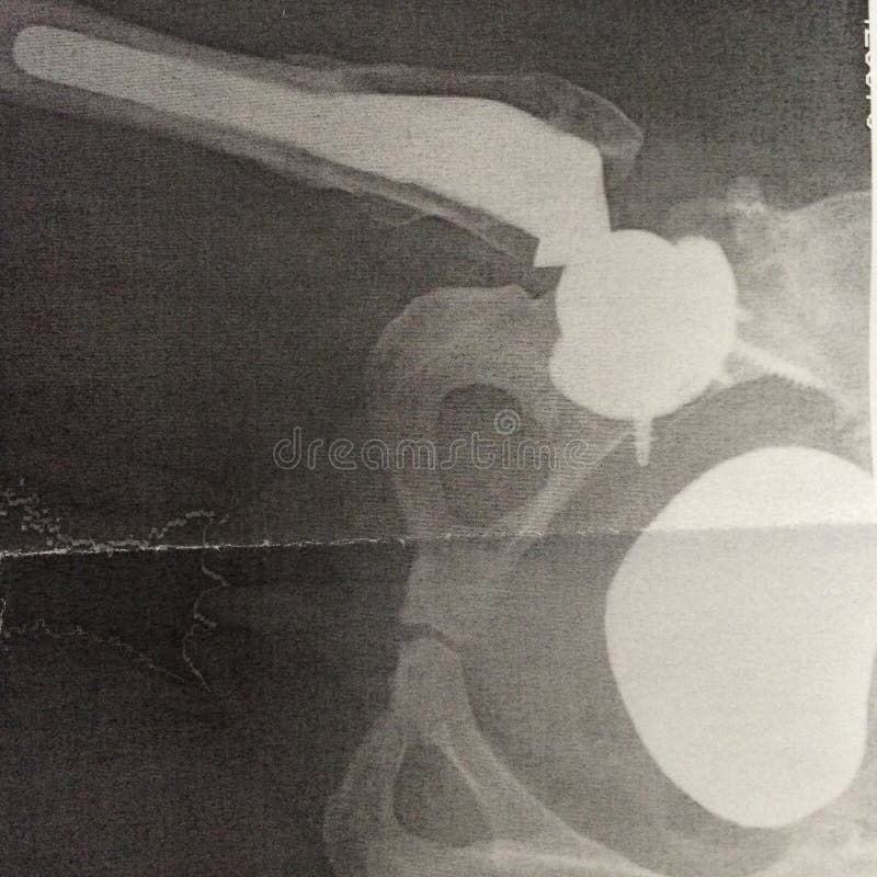 Replacement hip stock photo. Image of socket, spike - 169310854