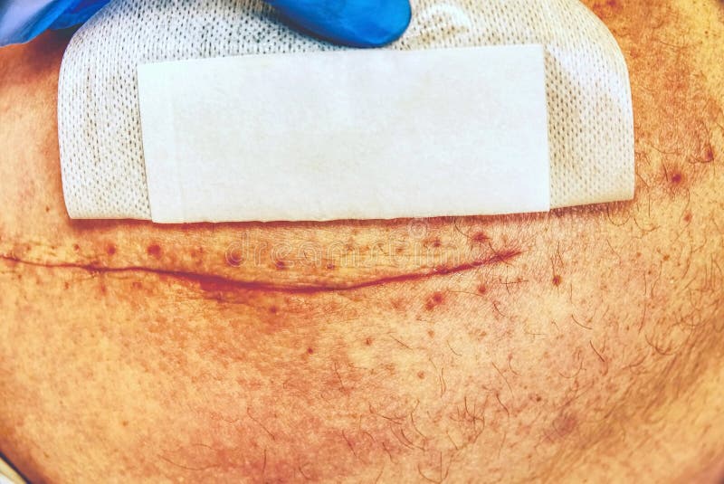 Pacemaker Scar Photos - Free & Royalty-Free Stock Photos from Dreamstime
