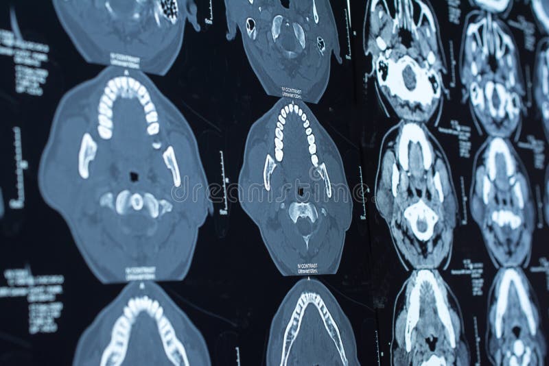 Research in Medicine. CT Scan of the Patient Stock Image - Image of ...