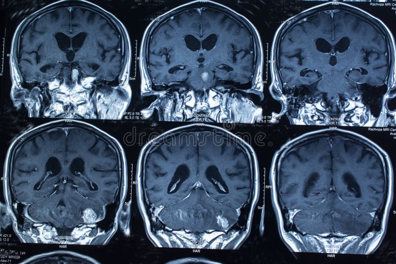 Research in Medicine. CT Scan of the Patient Stock Photo - Image of ...