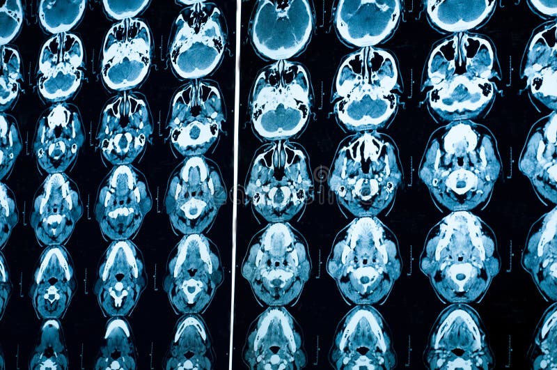 Normal head on CT scans stock photo. Image of human, matter - 55979524