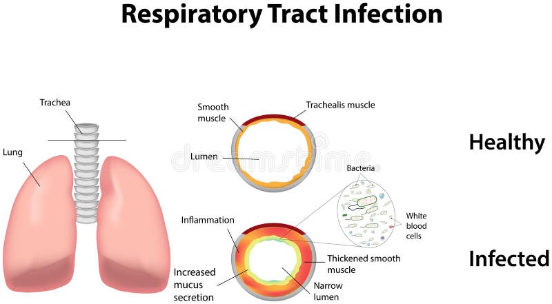 Respiratory Bacteria Stock Illustrations – 30,673 Respiratory Bacteria ...