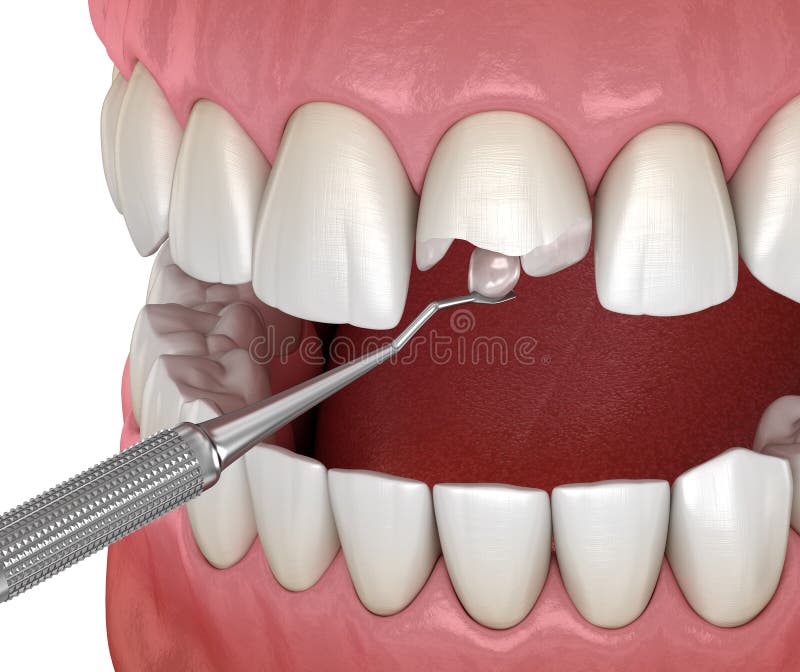 Restoration of Broken Tooth. Medically Accurate 3D Illustration Stock ...