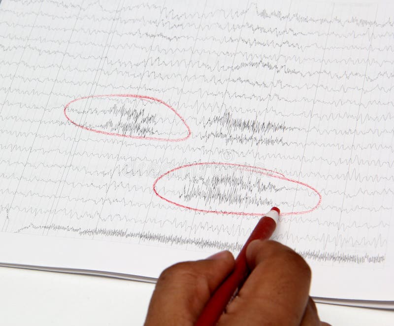 Results of an Electroencephalogram after a Neurophysiological ...