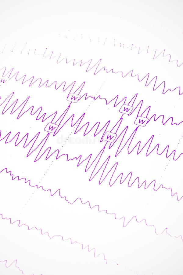Results of Electroencephalogram on Paper, Diagnostics of Epilepsy Stock ...
