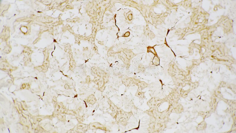 Lymph Node in Section Magnified Under Microscope in 400x Times on ...