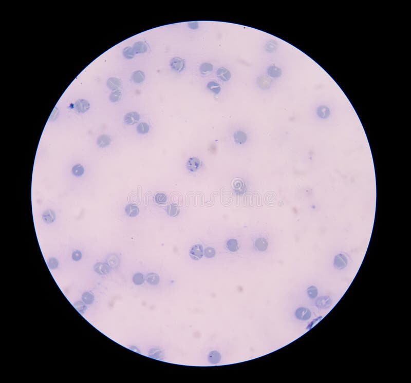 Reticulocytes photo stock. Image du santé, cancer, biologie - 67925788