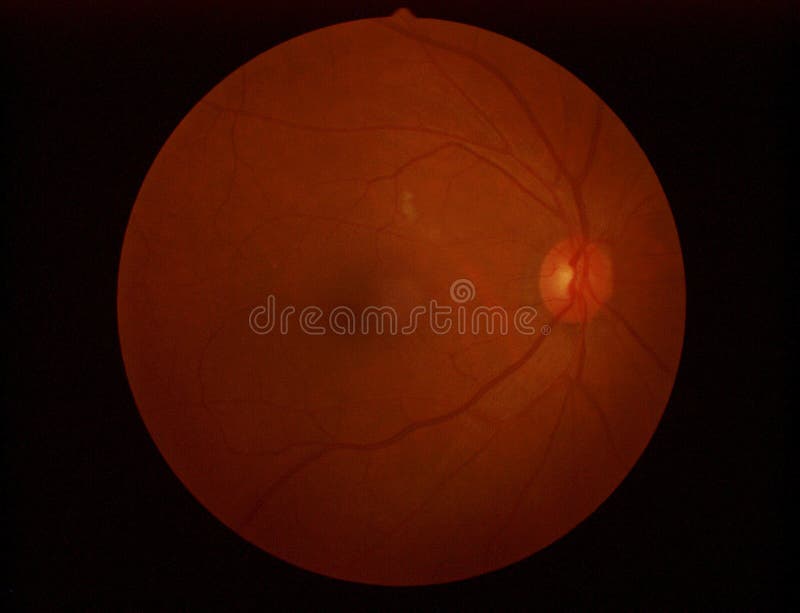 The Retina stock image. Image of ophthalmologist, healthcare - 44847051