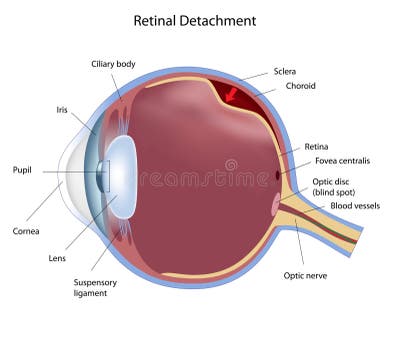 Retinal Detachment Vector Illustration Stock Illustrations – 66 Retinal ...