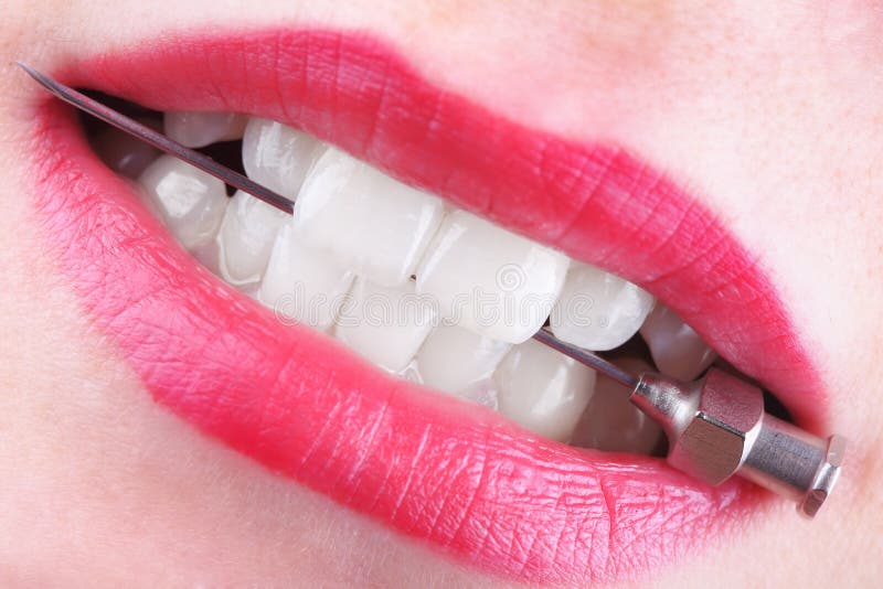 Retro Steel Needle in Female Teeth Stock Image - Image of hospital ...