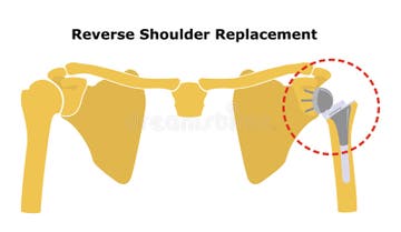 Reverse Shoulder Replacement Stock Illustrations – 10 Reverse Shoulder ...