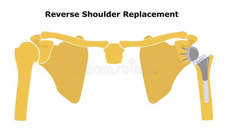 Reverse Shoulder Replacement. Shoulder Joint Replacement ...