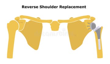 Reverse Shoulder Replacement Stock Illustrations – 10 Reverse Shoulder ...
