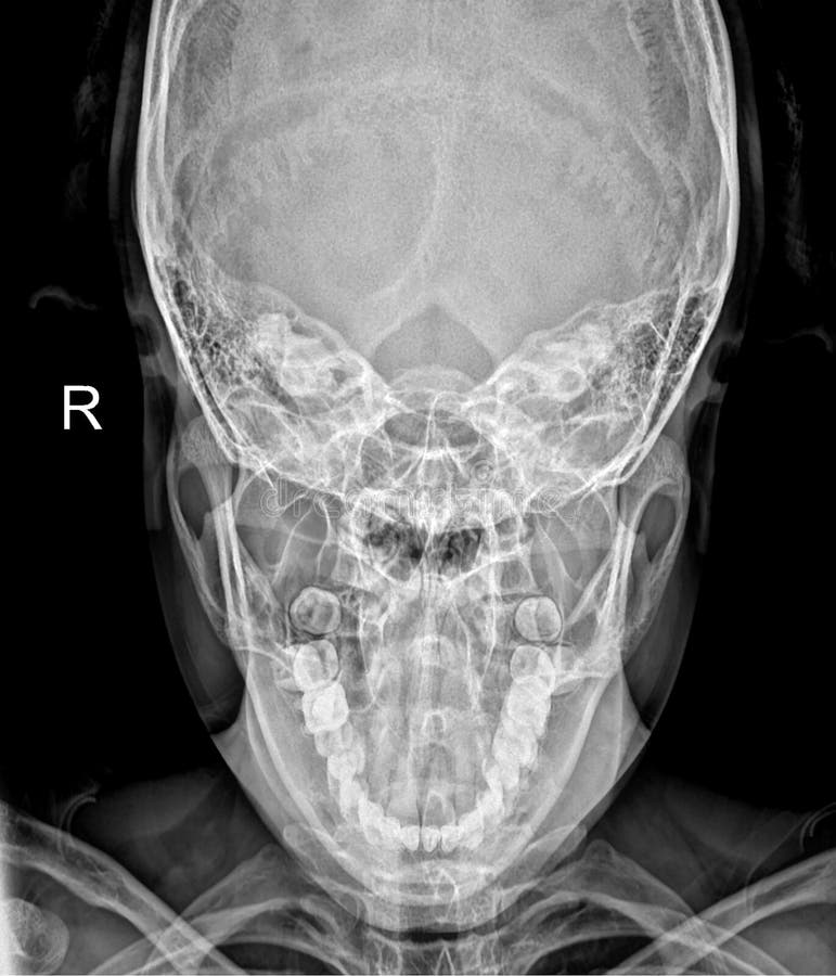 Reverse Towns PA View Radiograph Stock Image - Image of hospital ...