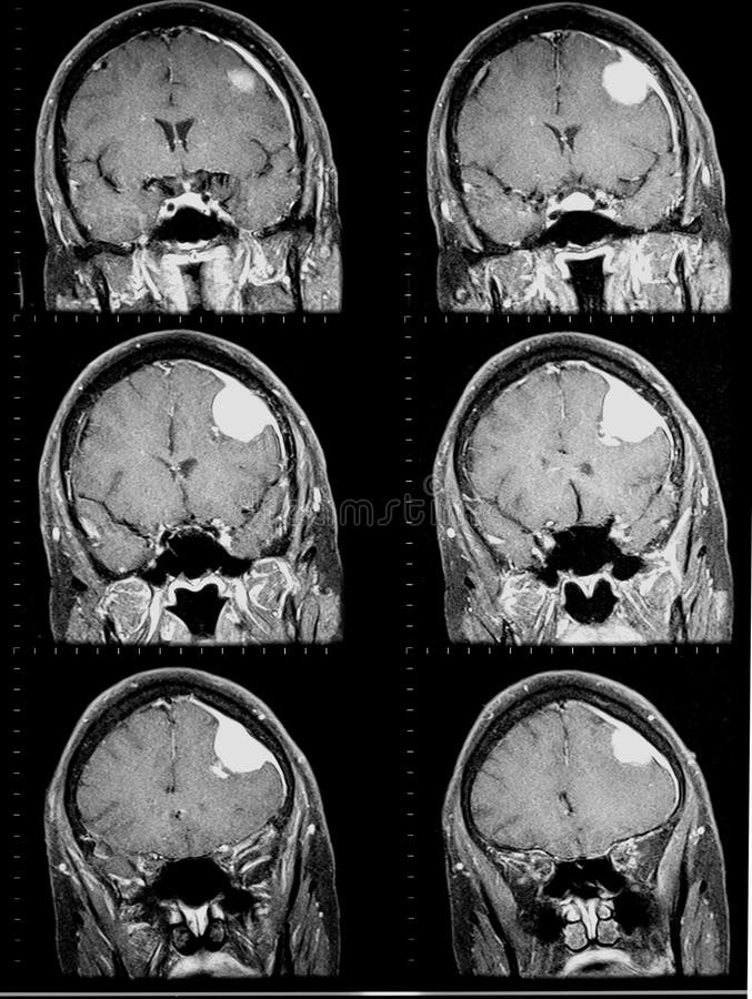 Rezonans Magnetyczny Mózgu Wykazujący Guz Mózgu Obraz Stock - Obraz ...