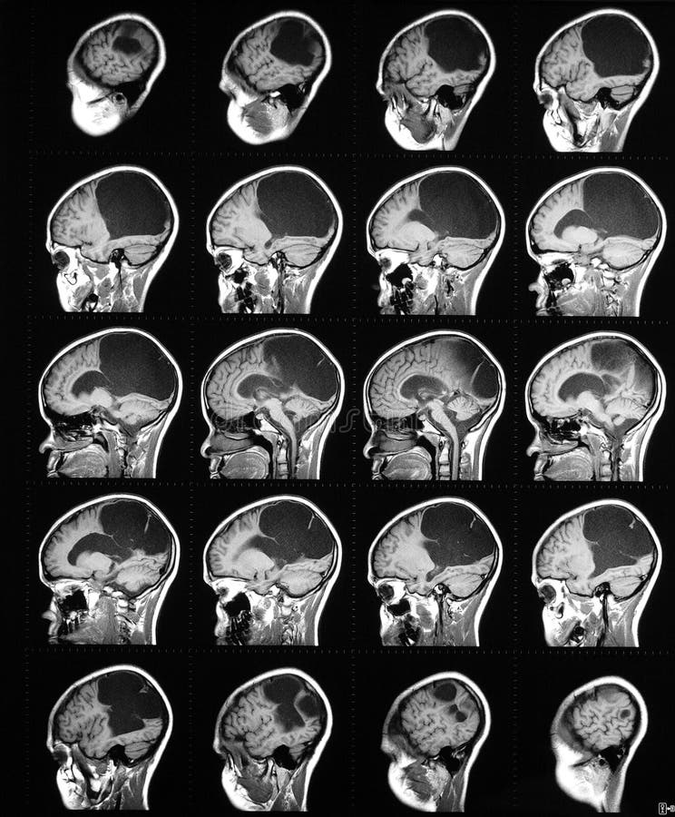 Guz Mózgu - Rezonans Magnetyczny Zdjęcie Stock - Obraz złożonej z ...