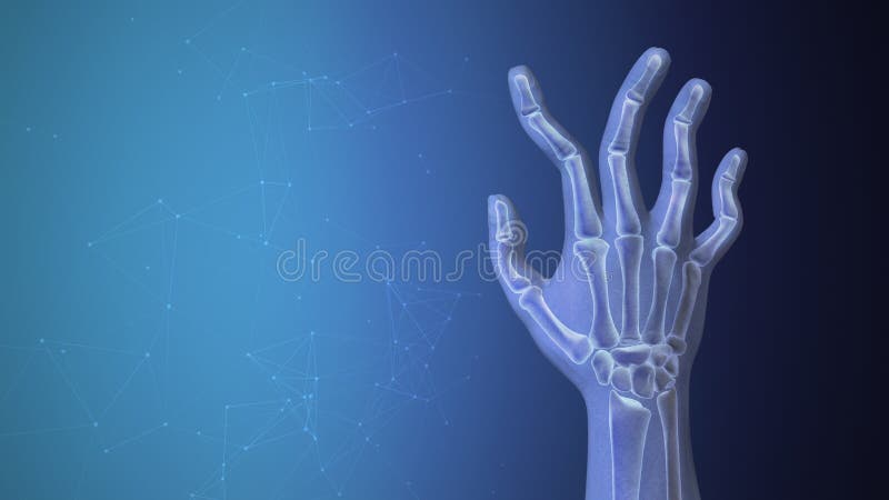 Rheumatoid Arthritis or Autoimmune Disorder Stock Illustration ...