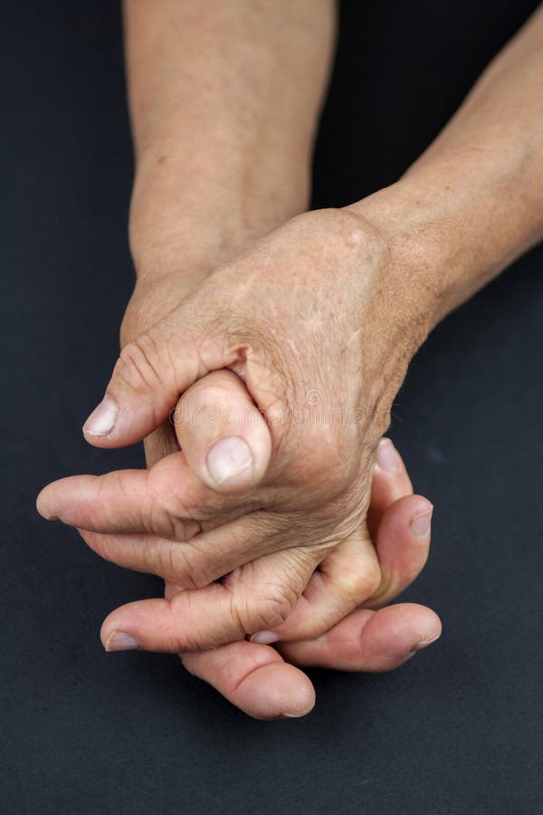 Rheumatoid arthritis hands stock image. Image of medicine - 42383061