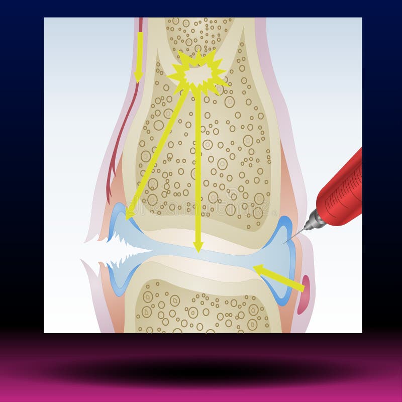 Rheumatoid Arthritis RA that Usually Affects Knees. the Auto Immune ...