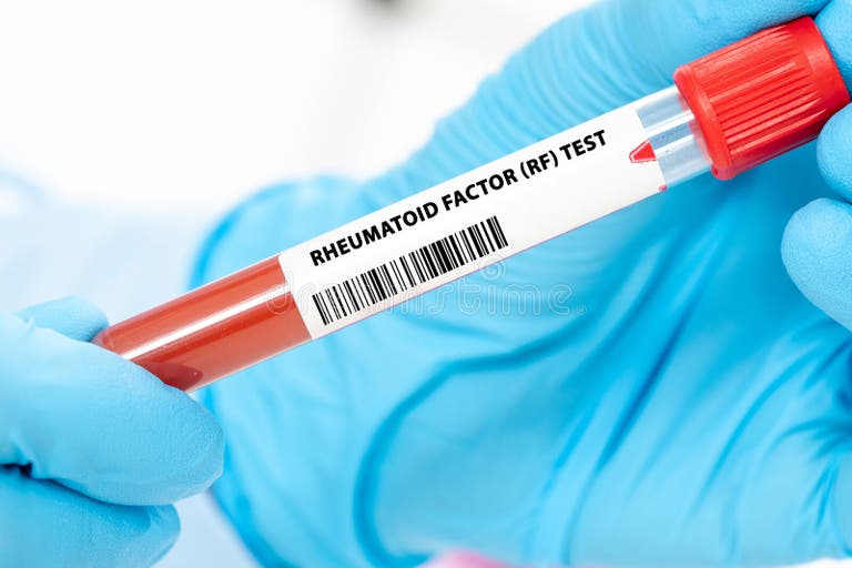 Rheumatoid Factor (RF) Test Stock Photo - Image of science, blood ...