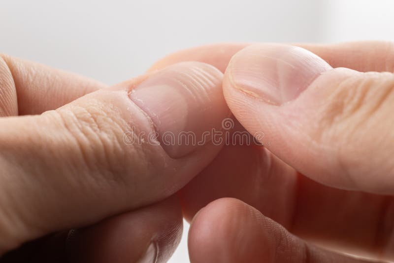 Ridged Fingernails with Vertical and Horizontal Ridges. Nails Problems ...