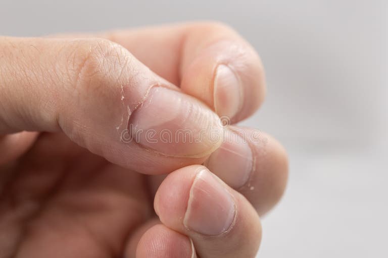 Ridged Fingernails with Vertical and Horizontal Ridges. Nails Problems ...