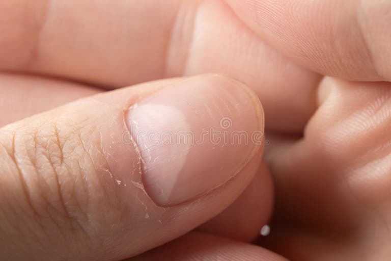 Ridged Fingernails with Vertical and Horizontal Ridges. Nails Problems ...